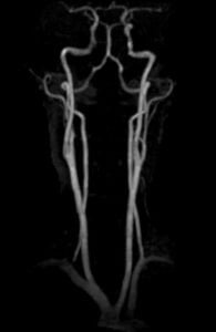 PLAN MRA NECK tof 3d mip - mrimaster