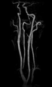 PLAN MRA NECK tof 3d mip - mrimaster