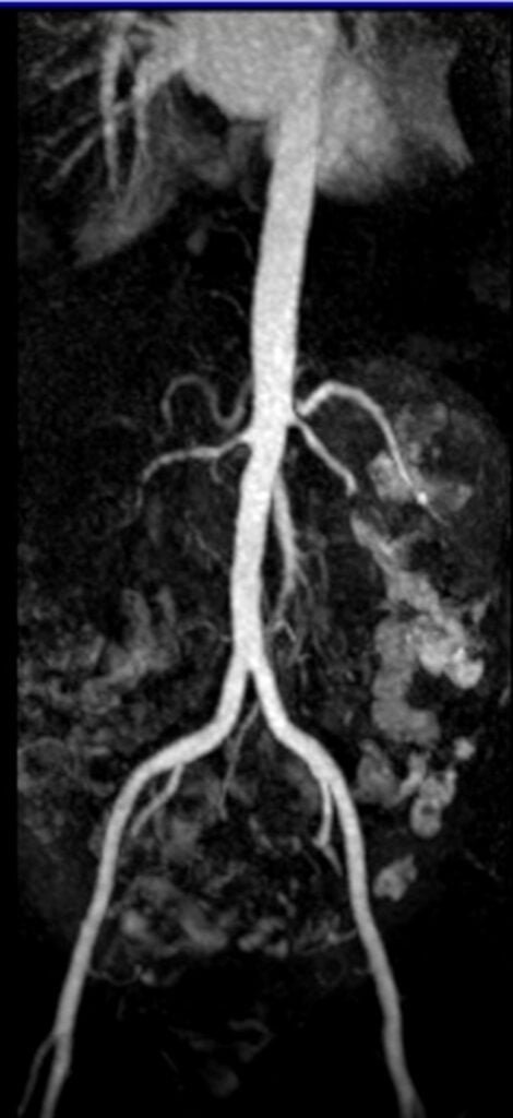 PLAN MRV ABD CORONAL FLASH POST MIP - mrimaster