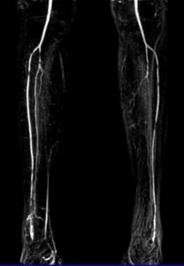 PLAN MRA W BODY FLASH LOWER LEG POST mip - mrimaster