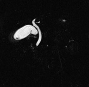 PLAN MRCP T2 TSE 3D - mrimaster