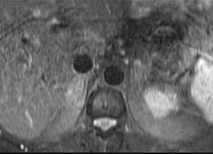 Adrenal MRI T2 TSE fat sat axial images