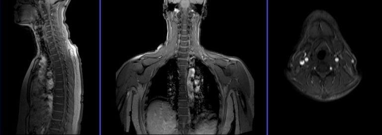 spinal cord mri protocols, planning and indications | multiple ...