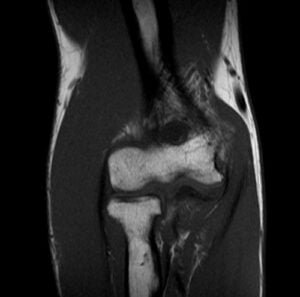 PLAN ELBOW t1 coronal - mrimaster