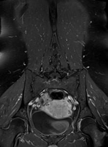 PLAN L PLEXUS t1 fs post cor - mrimaster