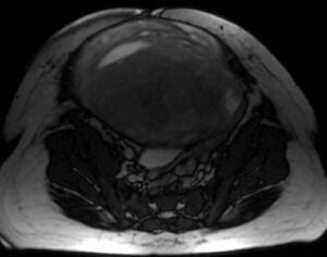 PLAN PLACENTA t2 axial obl - mrimaster