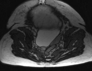 PLAN PLACENTA t2 axial obl - mrimaster