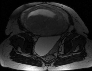 PLAN PLACENTA t2 axial - mrimaster