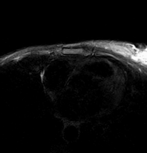 MRI strenum STIR axial images