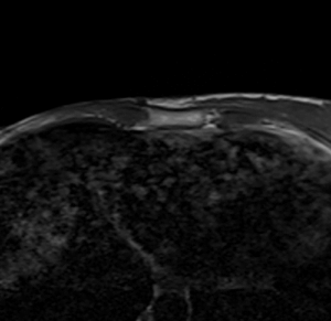 MRI strenum T1 axial image