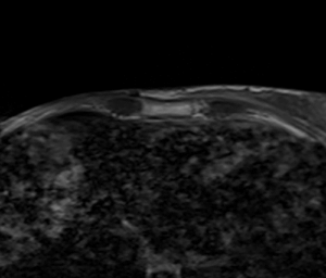 MRI strenum T1 axial post contrast images