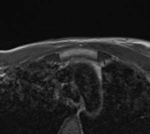 MRI strenum T1 axial post contrast images