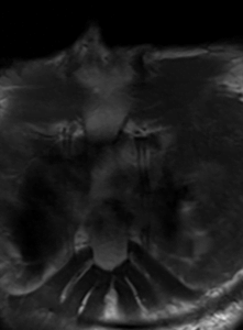 MRI strenum T1 coronal images