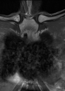 MRI strenum T1 coronal images