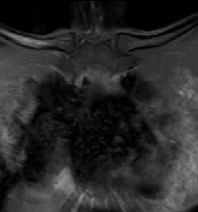 MRI strenum T1 coronal post contrast images