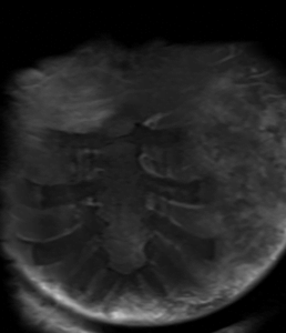 MRI strenum T1 coronal post contrast images