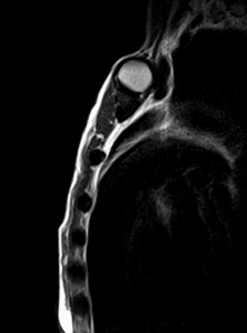 MRI strenum sagittal T2 images