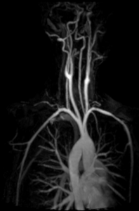 PLAN MRA SUBCLAVIANS t1 flash coronal arm down post mip - mrimaster