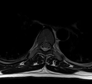 MRI thoracic spine T2 axial images