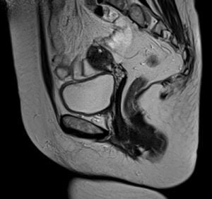 PLAN RV FISTULA sag t2 - mrimaster
