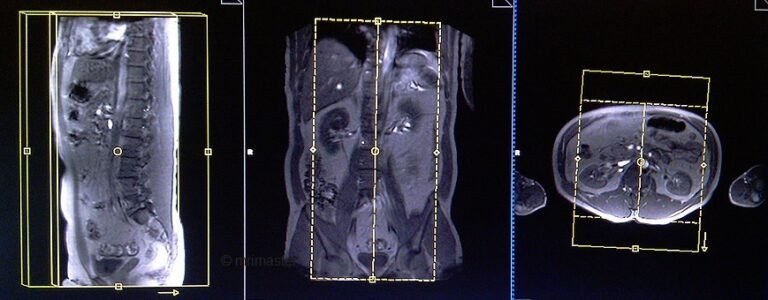 magnetic resonance angiography(MRA) whole body protocols and planning ...