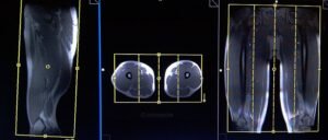 magnetic resonance angiography(MRA) whole body protocols and planning ...