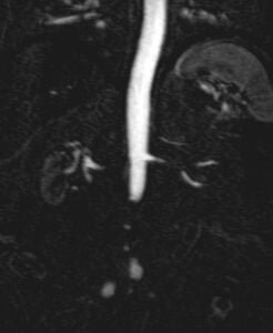 PLAN MRA RENAL coronal t1 fat sat post sub - mrimaster