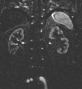 PLAN MRA RENAL coronal t1 fat sat post sub - mrimaster