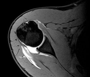 PLAN ARTRO SHOULDER AXIAL VIBE 3D - mrimaster