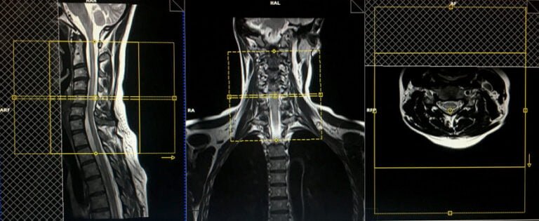 spinal cord mri protocols, planning and indications | multiple ...