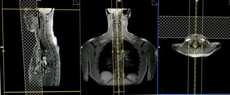 spinal cord mri protocols, planning and indications | multiple ...