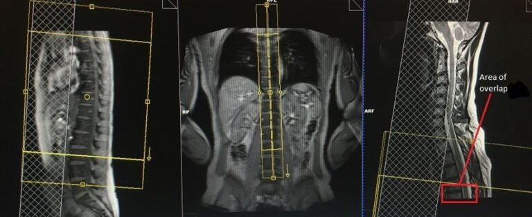 spinal cord mri protocols, planning and indications | multiple ...