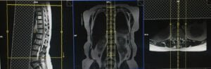 spinal cord mri protocols, planning and indications | multiple ...