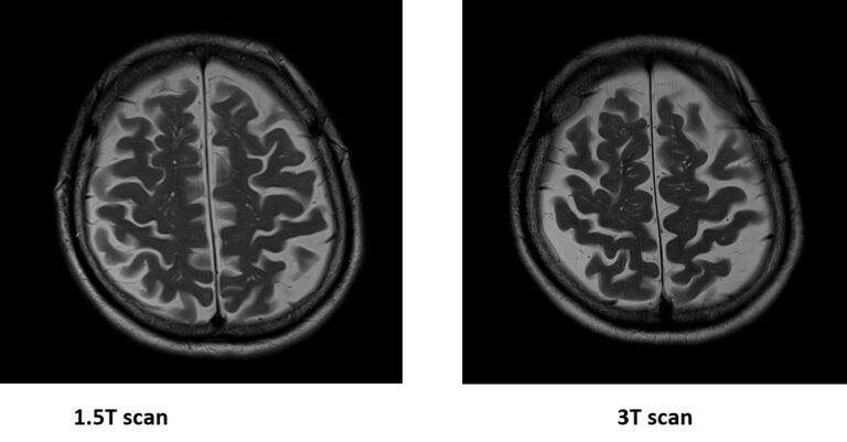 MRI Signal-to-noise ratio related artifact | SNR artifacts