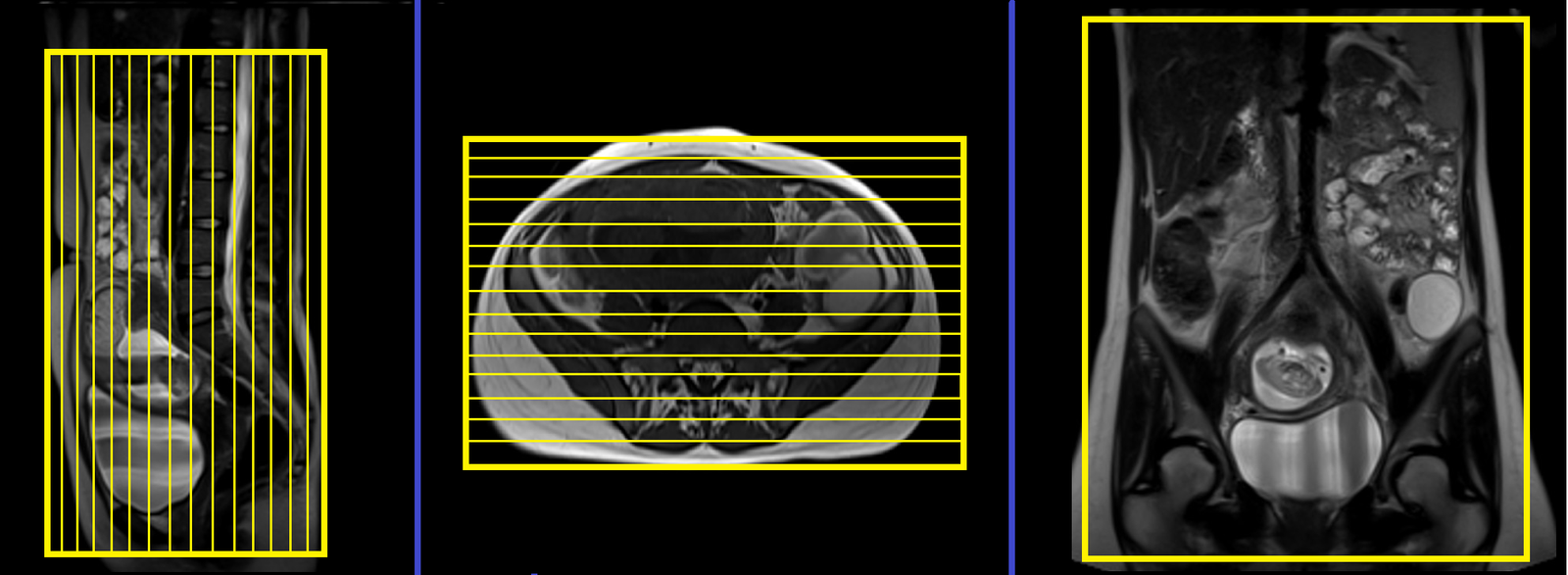 MRI Adnexal Mass in Pregnancy | Adnexal Mass in Pregnancy Protocol