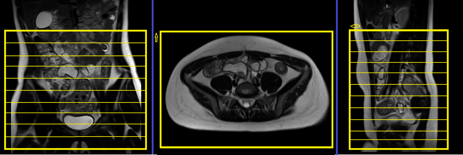 Appendix MRI | Appendix MRI Protocol and Planning