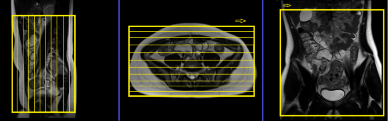 Appendix MRI | Appendix MRI Protocol and Planning