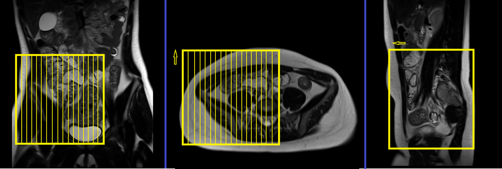 Appendix MRI | Appendix MRI Protocol and Planning
