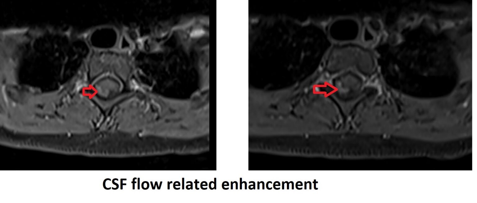 flow artifact mri | csf flow artifact