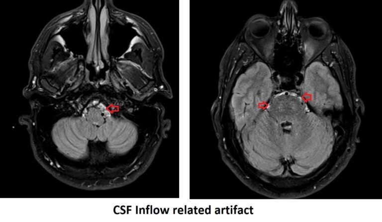 flow artifact mri | csf flow artifact