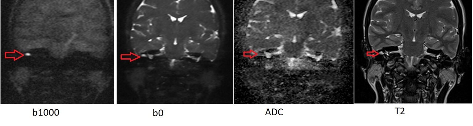 Cholesteatoma(DWI IAM'S) MRI Protocols and Planning | Indications for ...