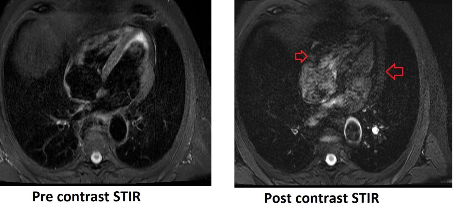 MRI Contrast media related artifacts