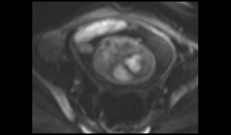 fetal brain mri axial epi dwi images