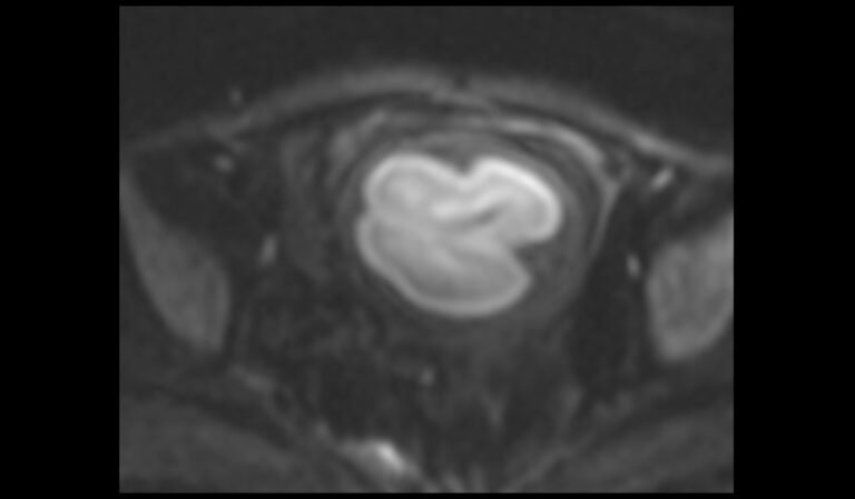 fetal brain mri axial epi dwi images