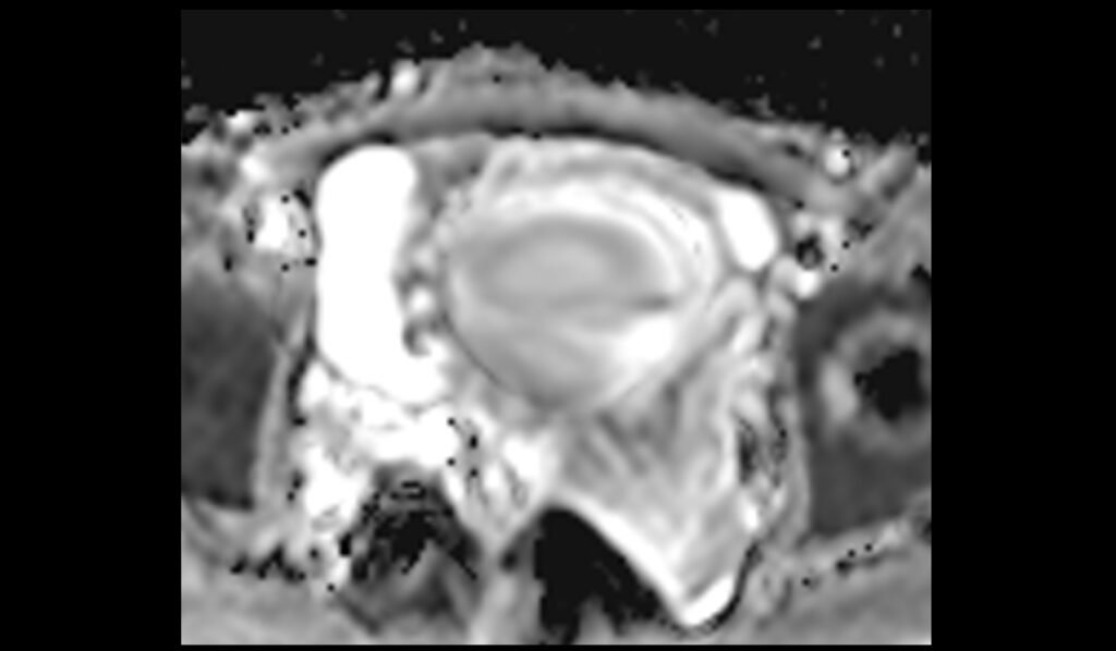 fetal brain mri axial epi dwi images
