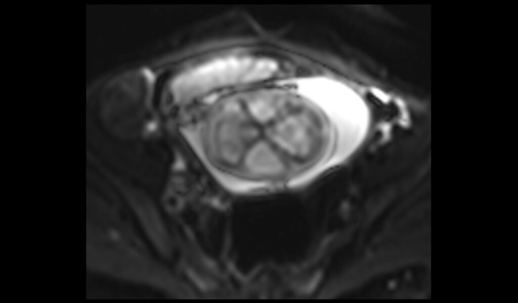 fetal brain mri axial epi dwi images