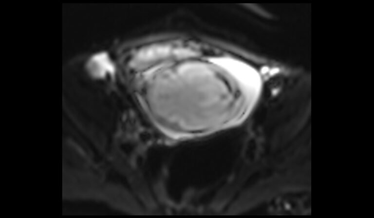 fetal brain mri axial epi dwi images
