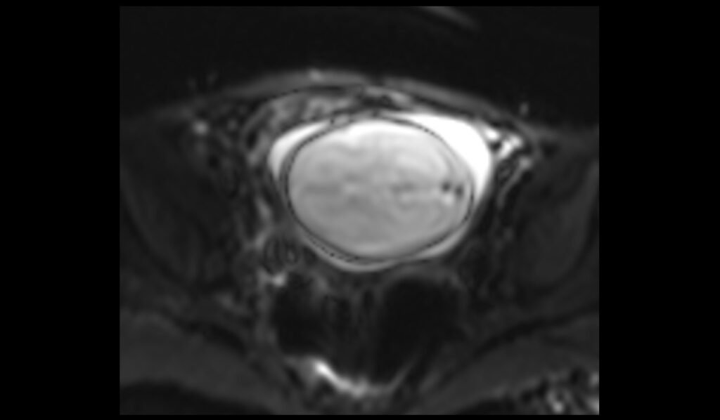 fetal brain mri axial epi dwi images