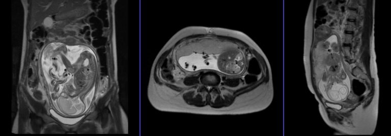 Fetal Brain MRI | Fetal Brain Scan Protocol and Planning