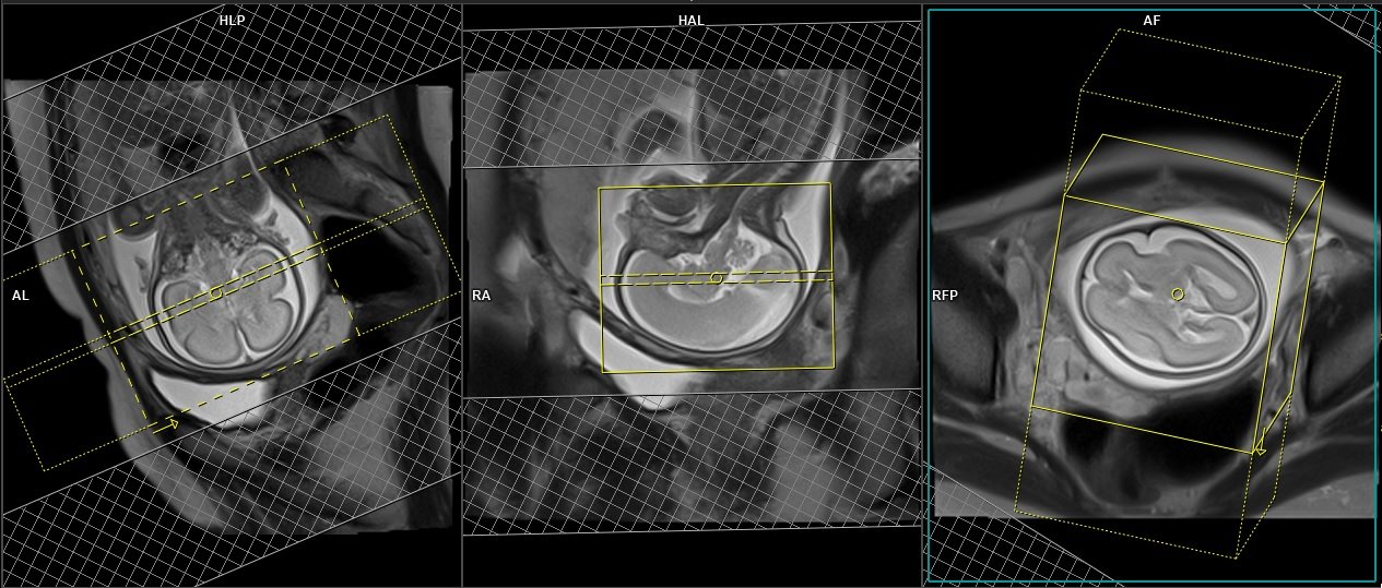 Fetal Brain MRI | Fetal Brain Scan Protocol and Planning
